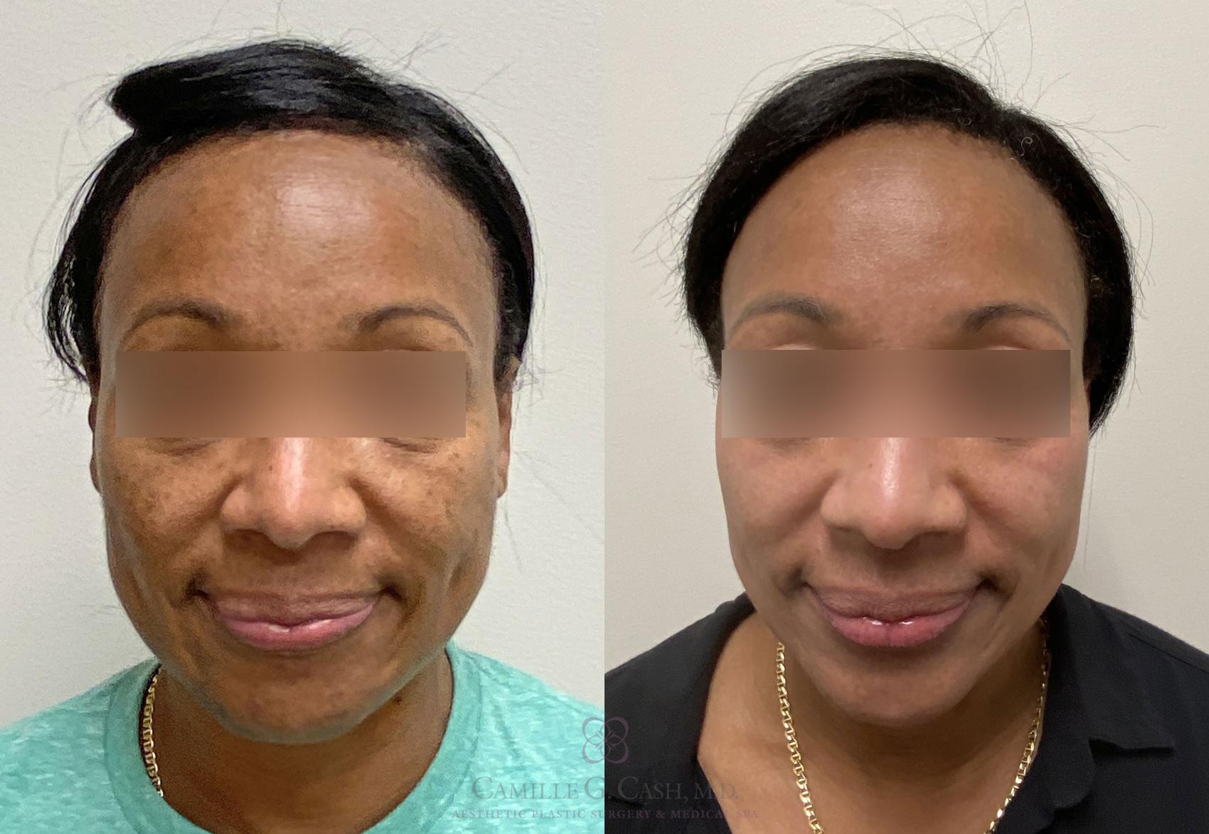 Houston Chemical Peel Options Dr Camille Cash Houston Chemical Peel Options Dr Camille Cash