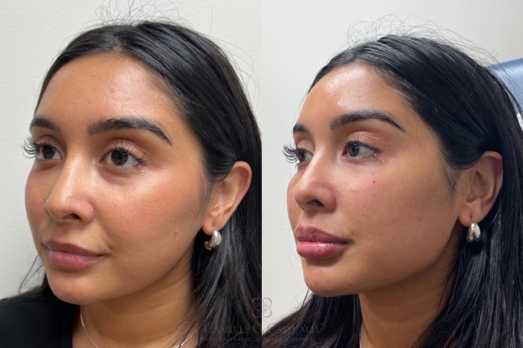 Dermal Fillers Before and After Pictures Case 683 | Houston, TX ...