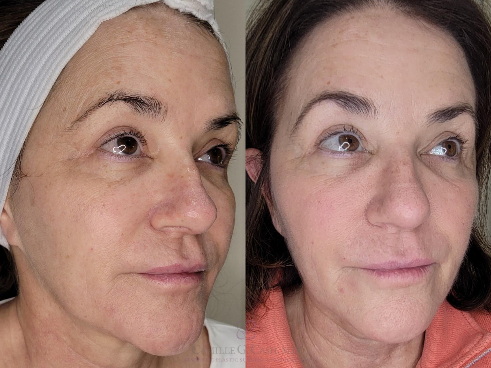 Melanage Peel Before and After Pictures Case 681 | Houston, TX | Camille Cash, M.D.